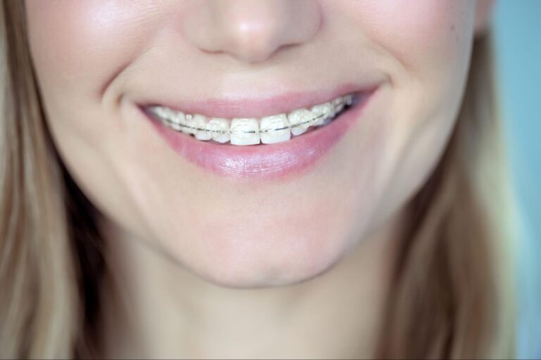 Everything You Need to Know About Lightforce Braces | Braces by Dr. Ruth